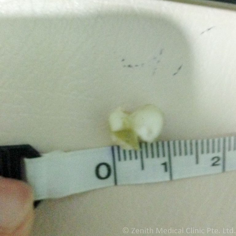 Earwax removal and ENT services, Singapore | Zenith Medical