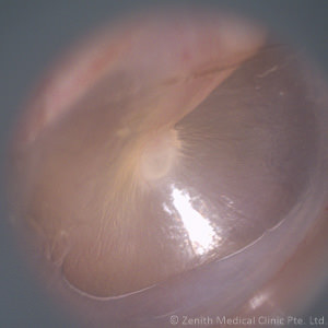 Middle ear infection | Zenith Medical