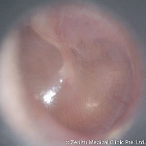Middle ear infection | Zenith Medical